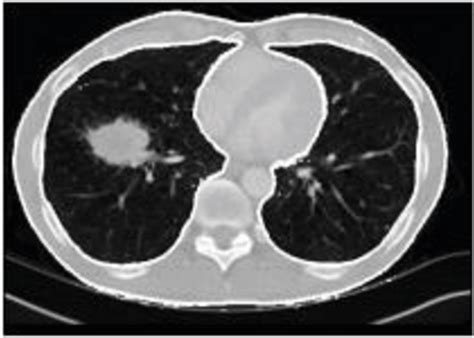 Figure 1 From Detection And Classification Of Lung Tumors Using Machine Learning Algorithms