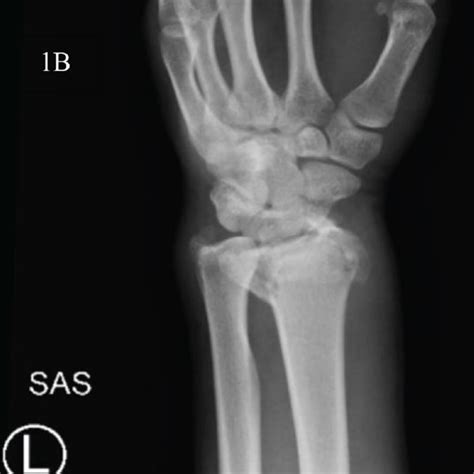 Left Wrist Pa A Oblique B And Lateral C Injury Radiographs