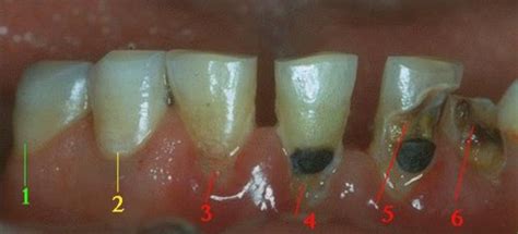 Caries And Non Caries Lesion Diagnosis Flashcards Quizlet