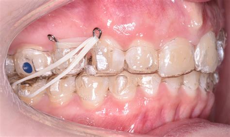 Three Reasons I Use Aligner Auxiliaries Dr Aisling Byrne S Protocols