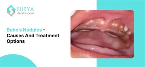 Bohns Nodules Causes And Treatment Options