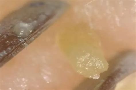 Pimples Being Popped Under A Microscope Is The Latest Disgusting Obsession And People Are
