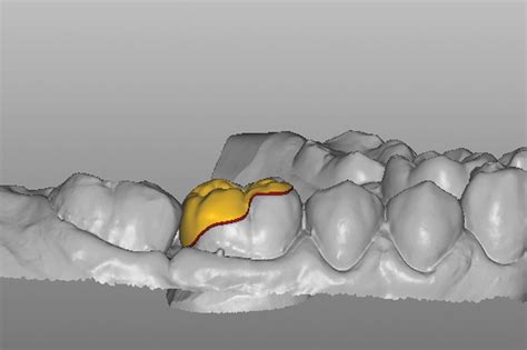 A Cad Cam Fabricated Aesthetic Onlay Case Dentistry