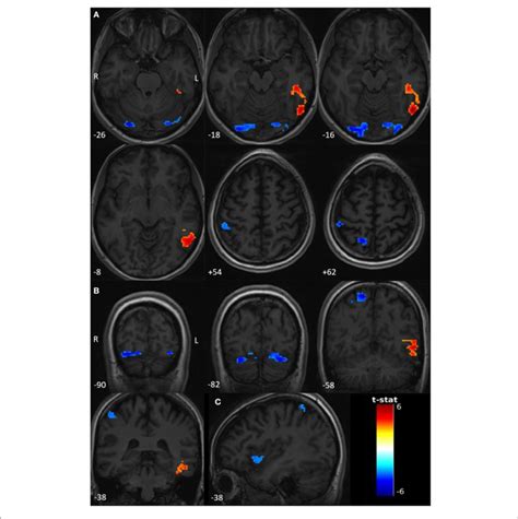 Functional Activations And Deactivations During Contrast Pnes Rest
