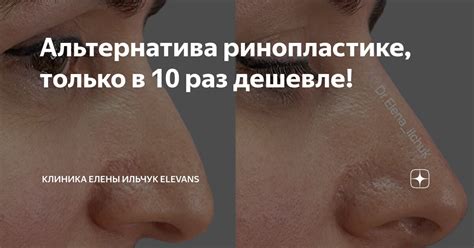 Альтернатива ринопластике только в 10 раз дешевле Клиника Елены Ильчук Elevans Дзен