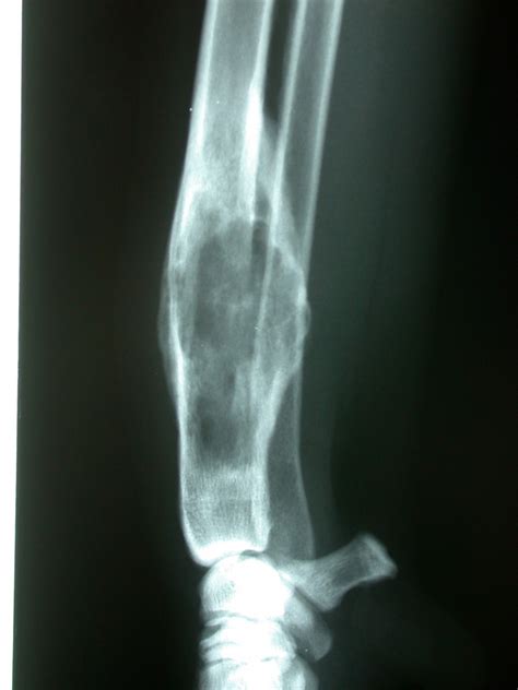 Osteosarcoma X Ray