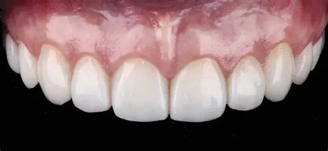 Direct Composite Veneers A Guide To Layering And Preparation