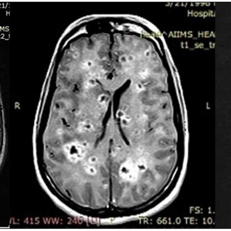 magnetic resonance imaging mri t2 t1 and diffusion restriction