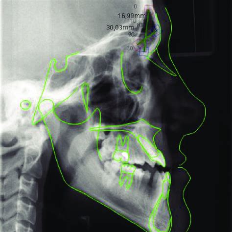 Determining Cephalometric Points And Evaluating Values Download