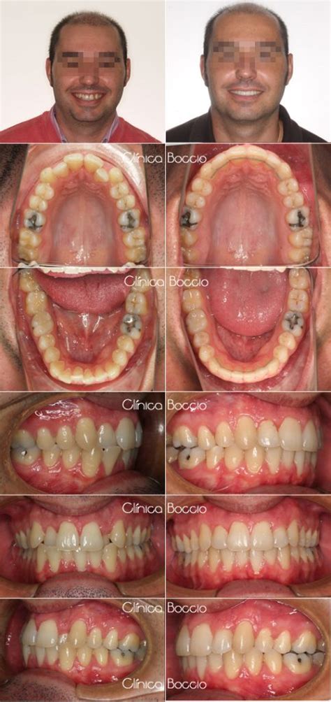 Mordida Cruzada Anterior Dra Leire Boccio
