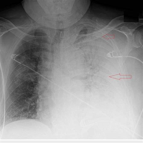 Chest X Ray Demonstrates Opacification Of The Entire Left Hemithorax