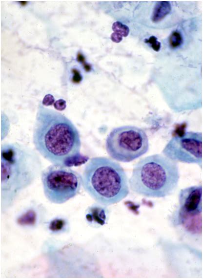 Atypical Squamous Cells Cannot Exclude Hsil Asc H Eurocytology