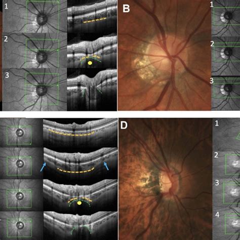 Subarachnoid Space Visibility Peripapillary Intrachoroidal Cavitation