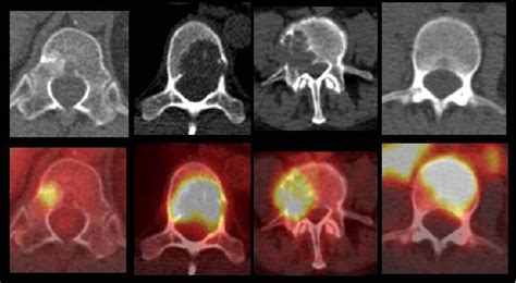 Types Of Bone Metastases In Lung Cancer A Blastic B Lytic C Download Scientific