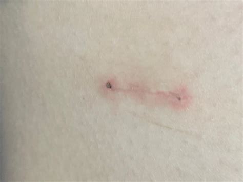 시술 수술 질문 자가늑 코수술 18 강남언니 1등 성형수술and피부시술 정보앱