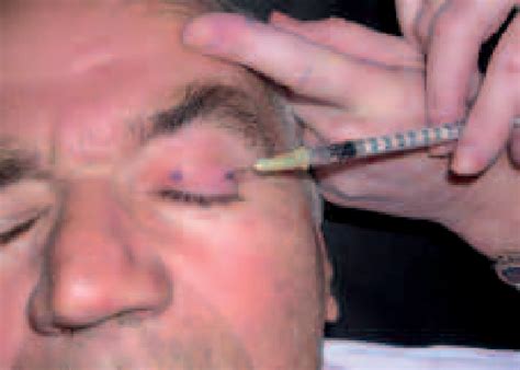 Levator Palpebrae Superioris Botox