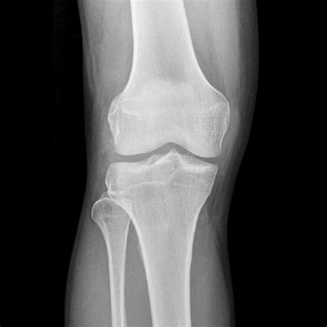 Knee Joint X Ray Image Ap View Stock Image Image Of Osteoporosis