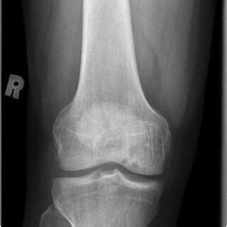 Pdf Brucellosis Unusually Presented As Septic Knee Arthritis A Case