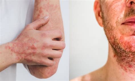 Psoriasis Vs Dermatitis Vs Eczema At Donald Hammond Blog