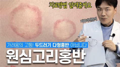 극심한 가려움의 고통 원심고리홍반 치료방법 두드러기 다형홍반 아니에요 연세에이엔비피부과 이해진 원장 Youtube