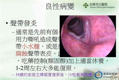 「燒聲」好多種 醫師：查明原因才能對症下藥 Ettoday健康雲 Ettoday新聞雲