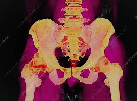 Osteoarthritis Of The Hip 3d Ct Scan Stock Image F0371425