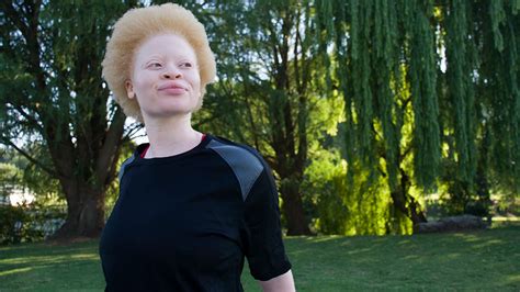 Albinism Medical Definition Albinism Types Symptoms And Causes Cimti