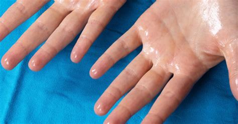Best Excessive Sweating Treatment In Malaysia Nextmed Clinic