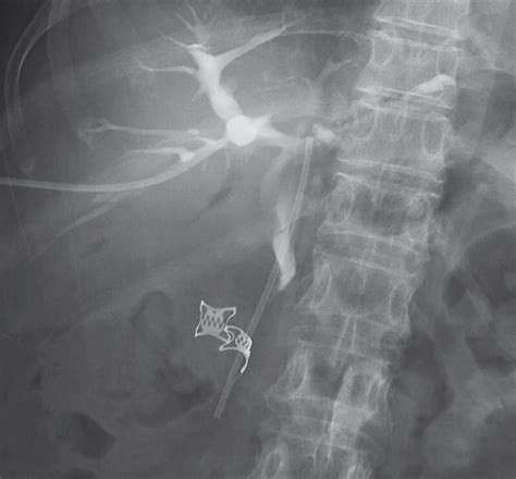 Acute Cholangitis After Over The Scope Clip Placement Involving The Duodenal Papilla That Was