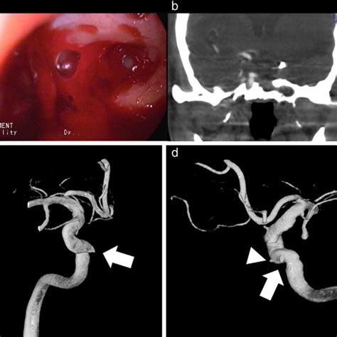 A Endoscopic Examination Showing Pulsatile Bleeding In The Sphenoid