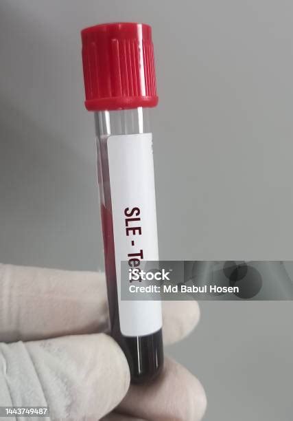 자가면역 질환 진단을 위한 전신성 홍반성 루푸스 검사를 위한 혈액 샘플 Internationale Funkausstellung Berlin에 대한 스톡 사진 및 기타 이미지