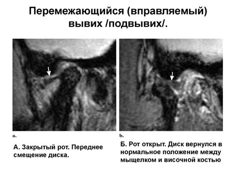 Височно нижнечелюстной сустав МРТ исследование презентация онлайн
