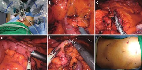 Figure2 Single Plus One Port Right Colectomy With Intracorporeal Download Scientific Diagram