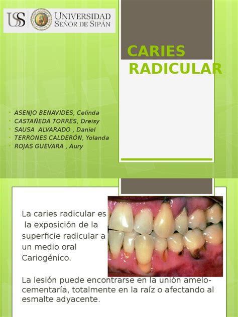 Caries Radicular 2 Expo Pdf Diente Humano Odontología