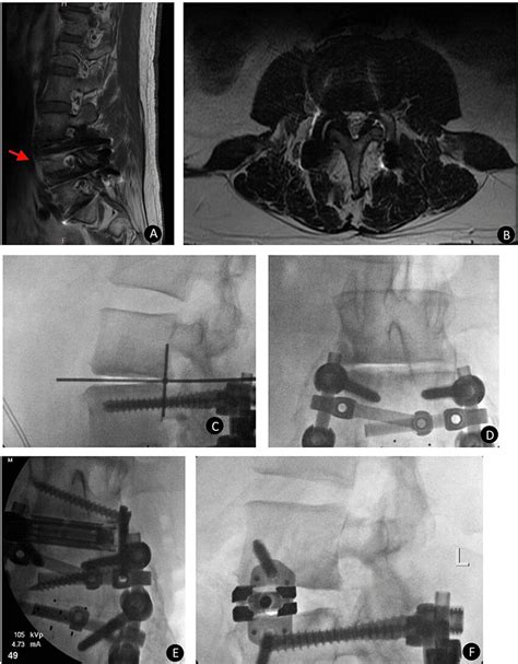 Case 4 Postoperative Radiographic Evaluation Of Dual Expandable Spacer