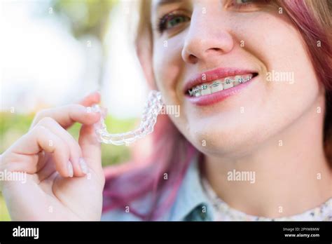 Dental Care Smiling Happy Girl With Braces On Her Teeth Holds Aligners In Her Hands And Shows