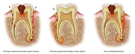 Understanding Periodontal Endodontic Infections April 2018 Inside