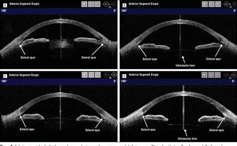 Anterior Chamber Angle