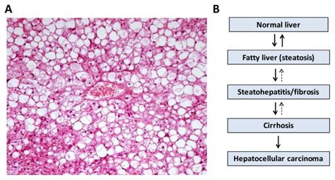 Fatty Liver Histology