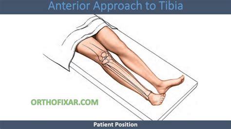 Anterior Approach To Tibia Easily Explained Orthofixar