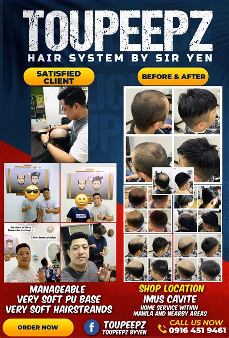 Scalp Solution Ph Scalp Micro Tattoo On Alopecia In Progress Smp Smpphilippines