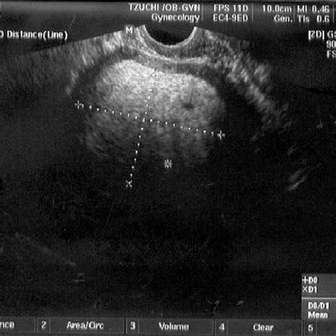 Pdf Lipoleiomyoma Of The Uterus