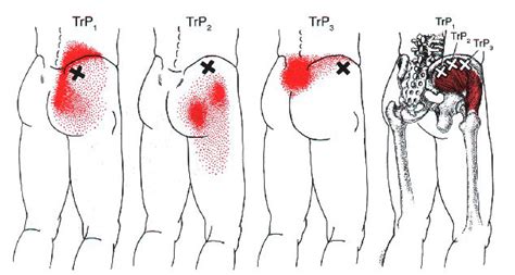Gluteus Medius The Trigger Point Referred Pain Guide