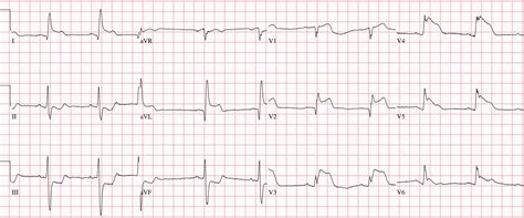 Sam Ghali M D On Twitter Here S An Important Ecg That Was Recorded In A 50 Year Old Man