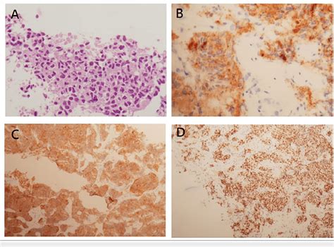 Photomicrograph Showing The Presence Of An Epithelial Proliferation