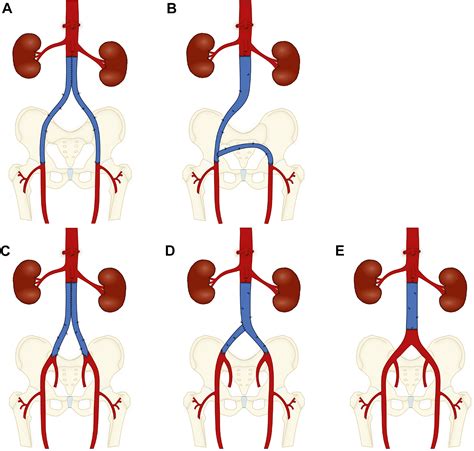 Contemporary Experience Of The Neo Aortoiliac System Nais Procedure