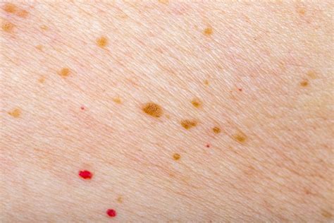 What Are Red Pinpoint Spots On Skin Roomress