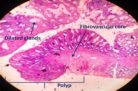 Rectal Polyp 3 Cm In Size Download Scientific Diagram