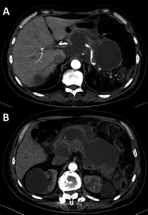Open Necrosectomy Is Feasible As A Last Resort In Selected Cases With