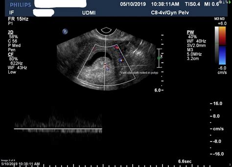 Fertility Test Hysterosonogram At Cristal Lawrence Blog